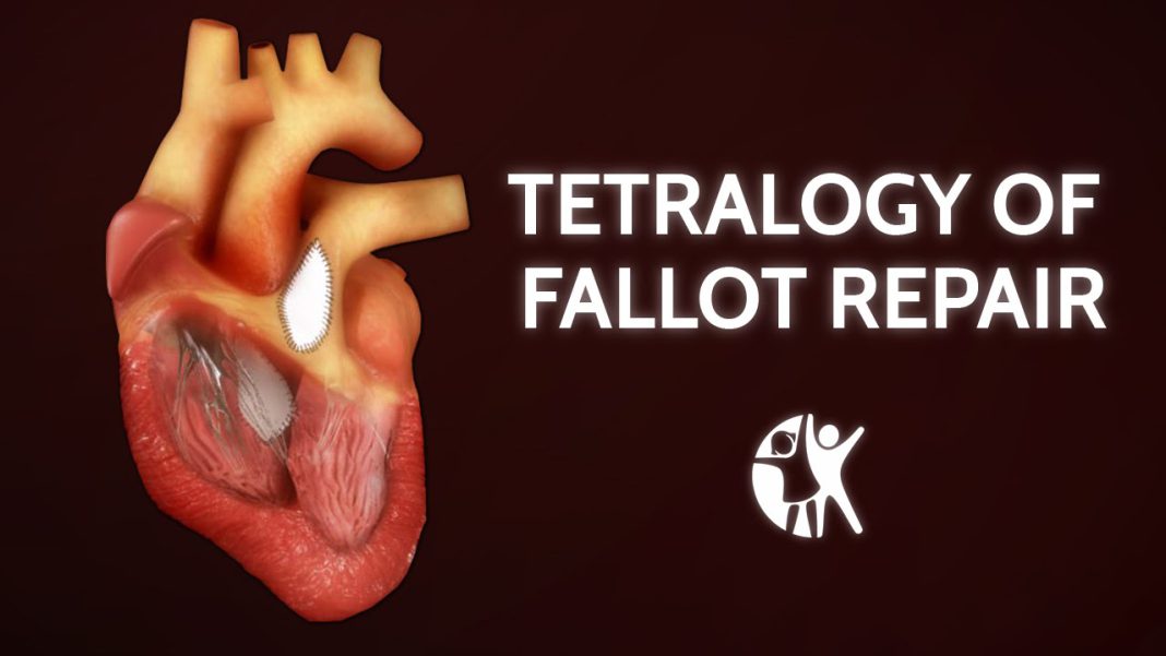 Tetralogy of Fallot Surgery - A Little Piece of Information